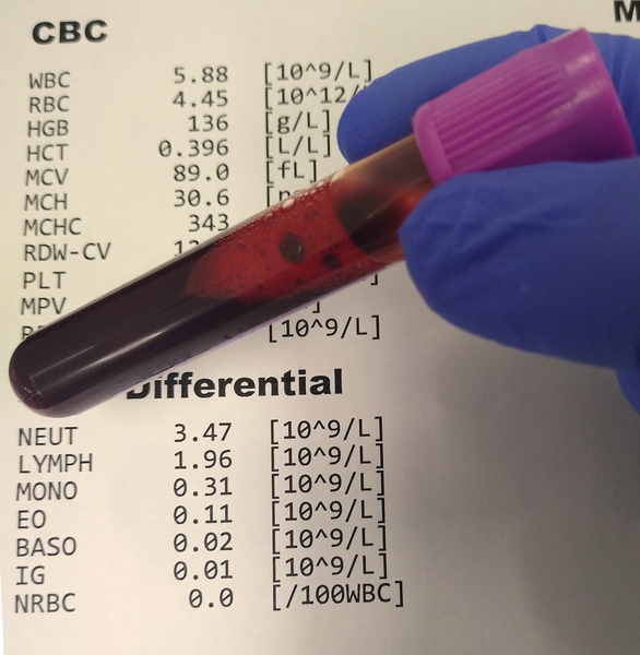 Because CBC or differential hemogram is important – MY FLORIDA LAB